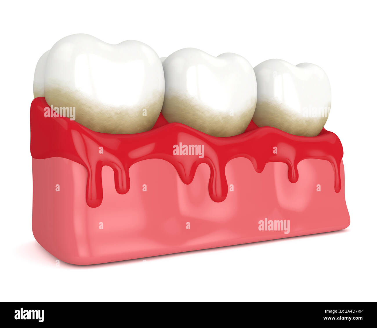 Periodontal Disease Bleeding Gums at Howard Bradshaw blog