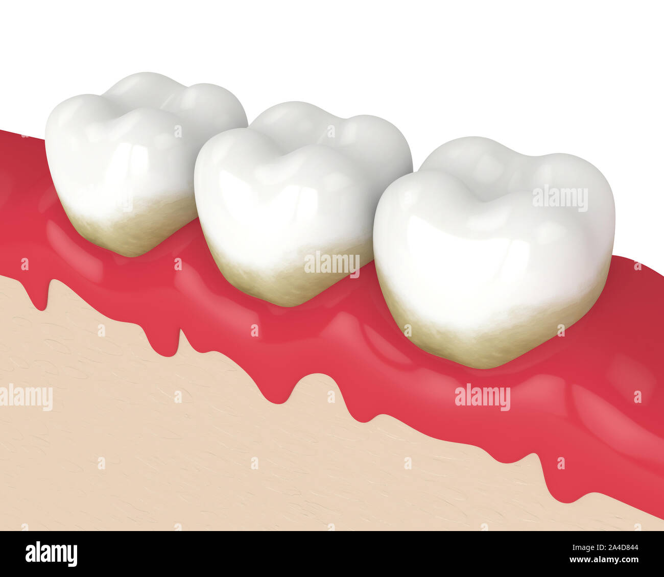 3d render of teeth in bleeding gums over white background. Periodontal ...