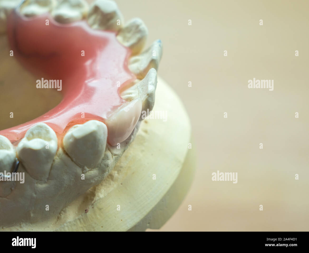 dental Tooth prosthesis Stock Photo - Alamy