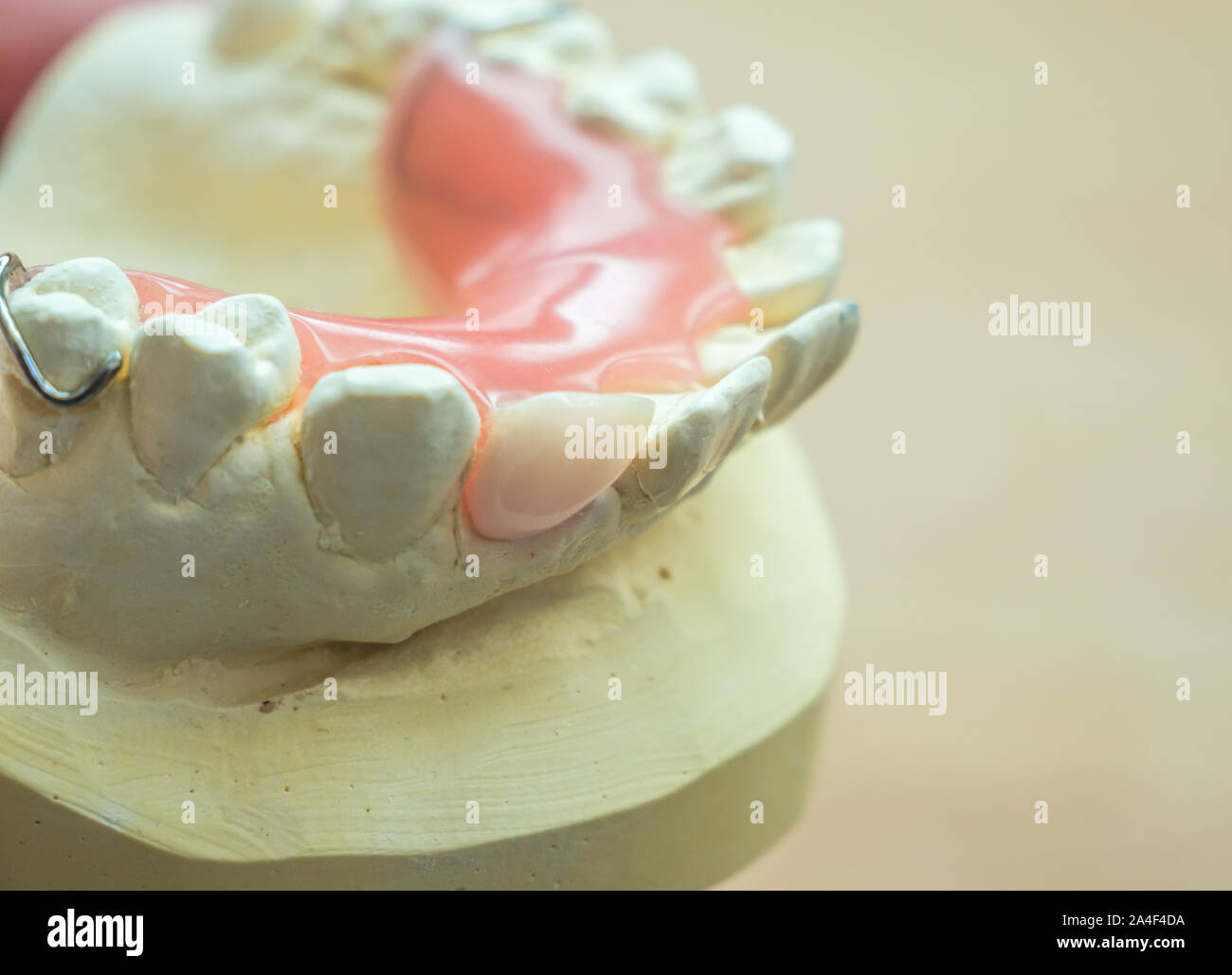 dental Tooth prosthesis Stock Photo - Alamy