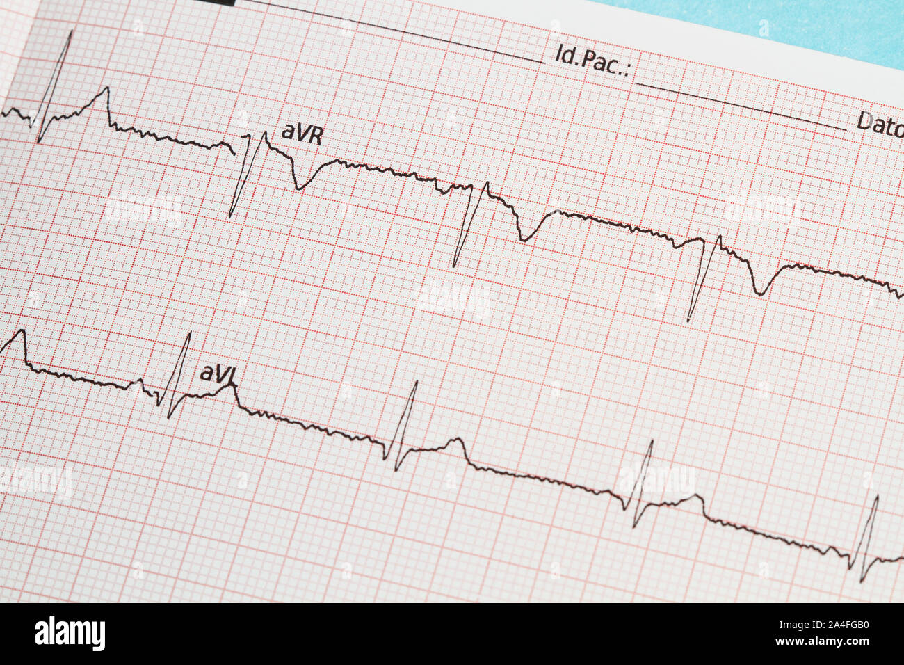 Ekg cardiac arrest hi-res stock photography and images - Alamy
