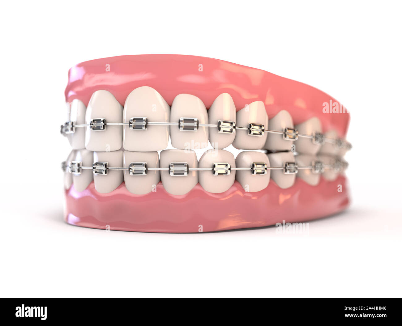 Perfect Teeth With Braces