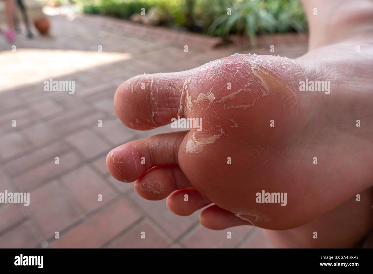 the skin detaches from one foot due to an illness Stock Photo - Alamy