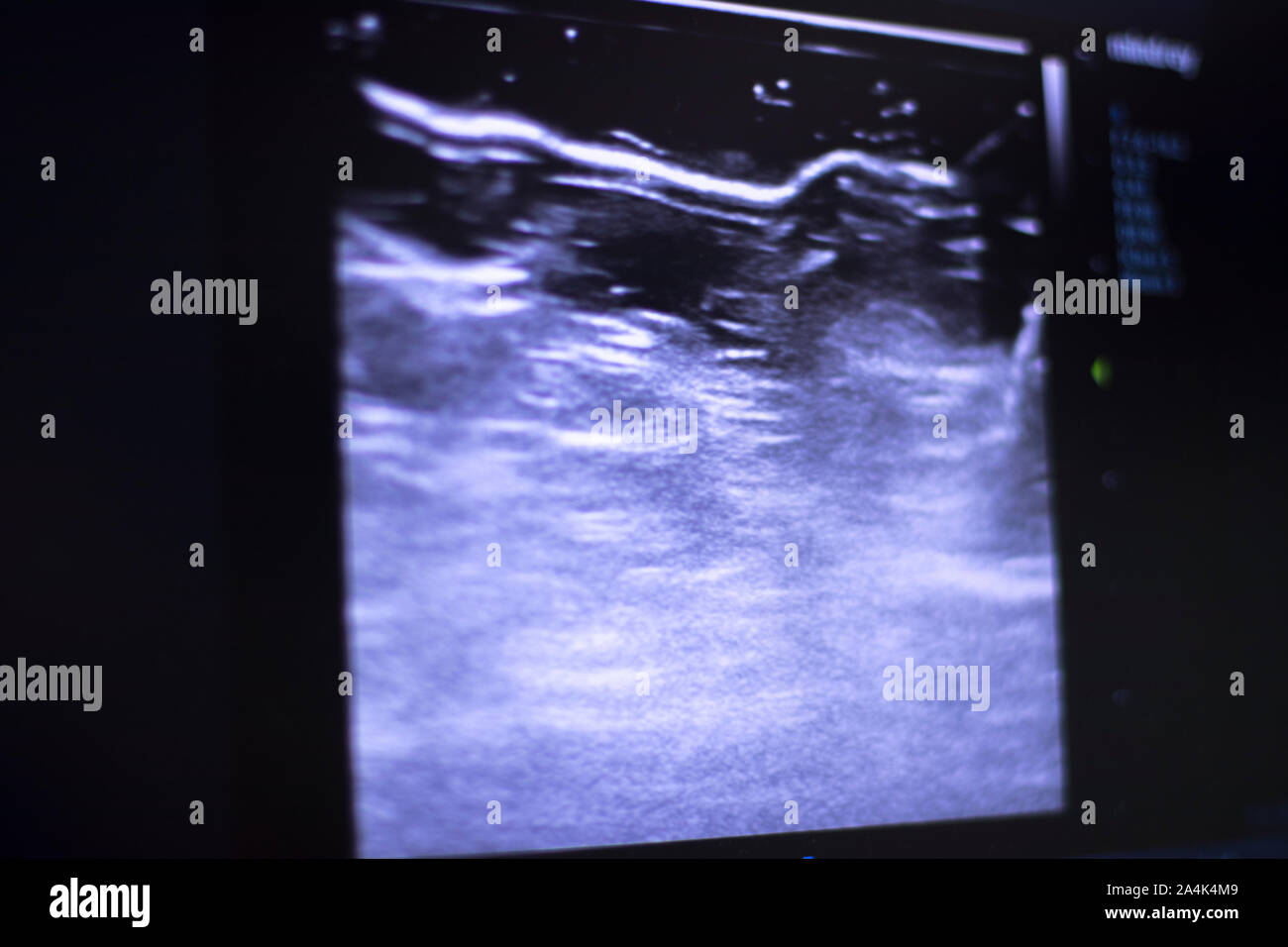 Epi percutaneous intratissue electrolysis scan hi-res stock photography and images - Alamy