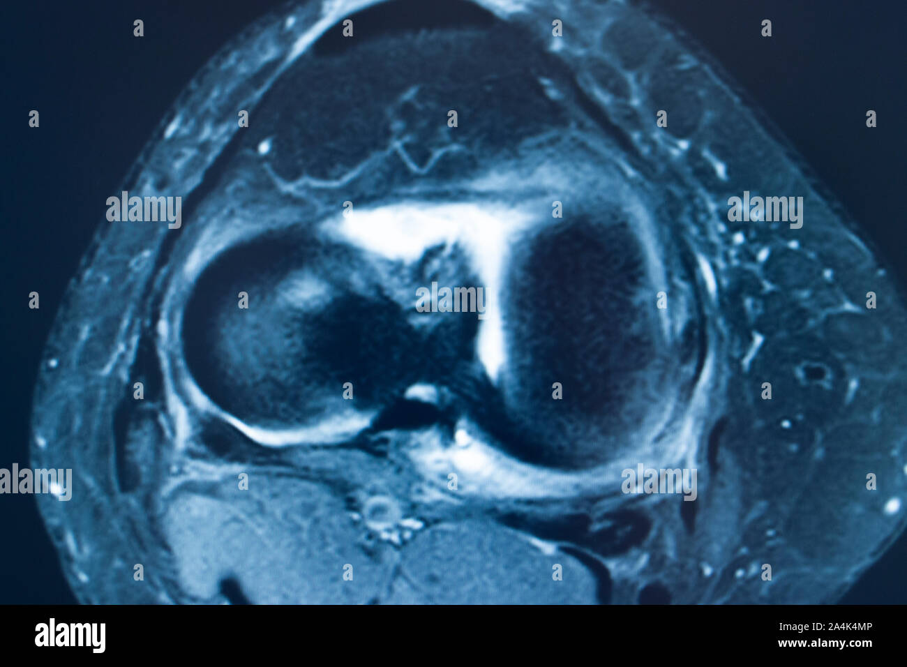 Knee sports injury mri mcl grade 2 tear magnetic resonance imaging ...
