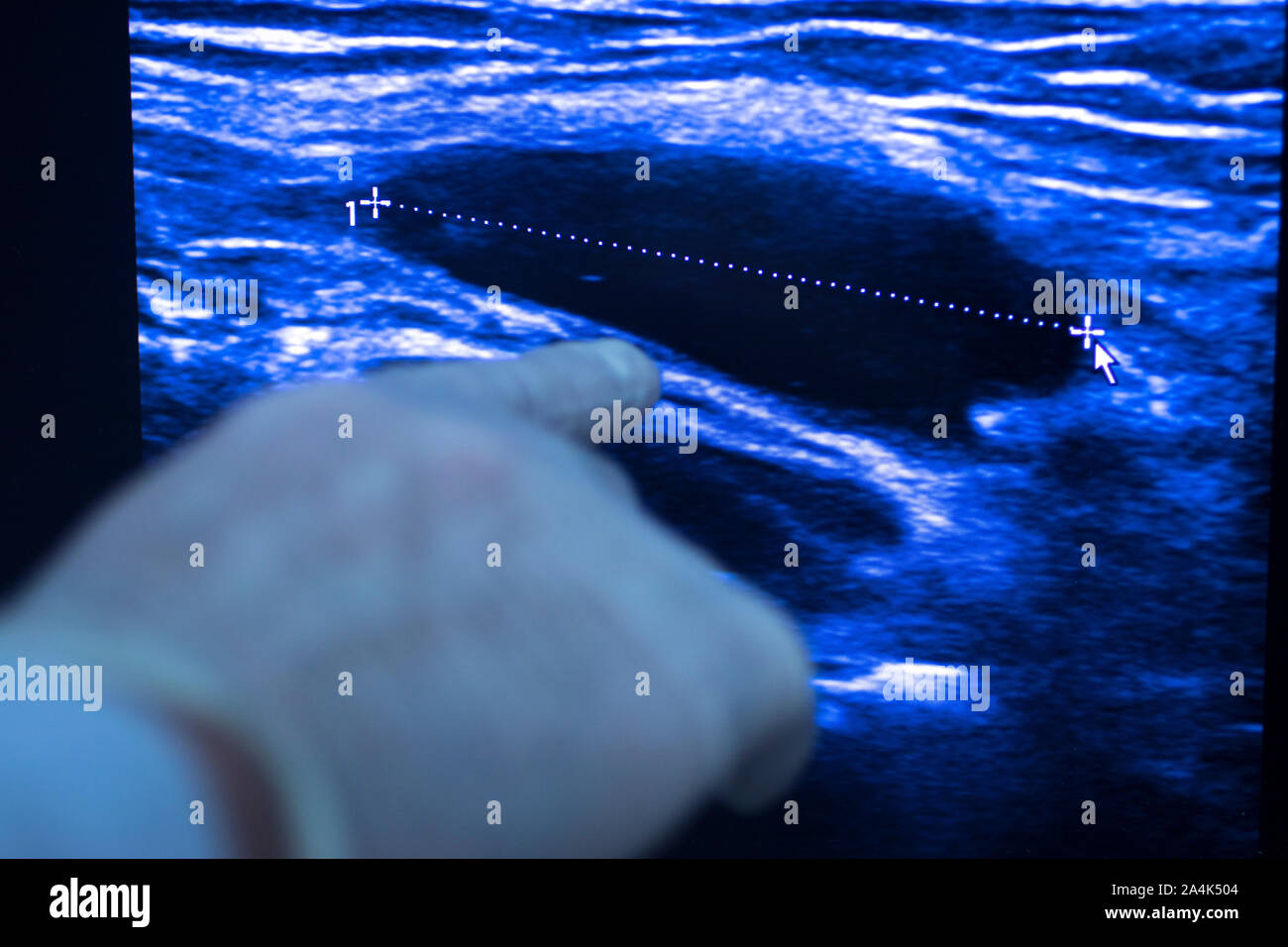 EPI Intratissue Percutaneous Electrolysis dry needling ultrasound ecography scan physiotherapy ...