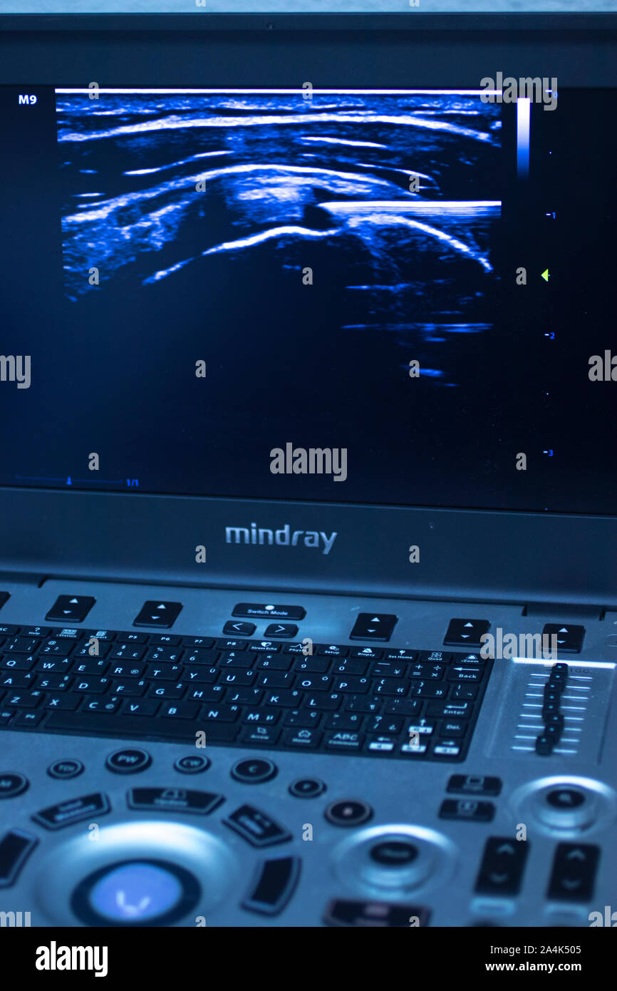 EPI Intratissue Percutaneous Electrolysis dry needling ultrasound ecography scan physiotherapy ...