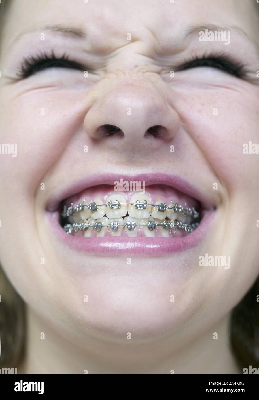 Girl with braces hi-res stock photography and images - Alamy