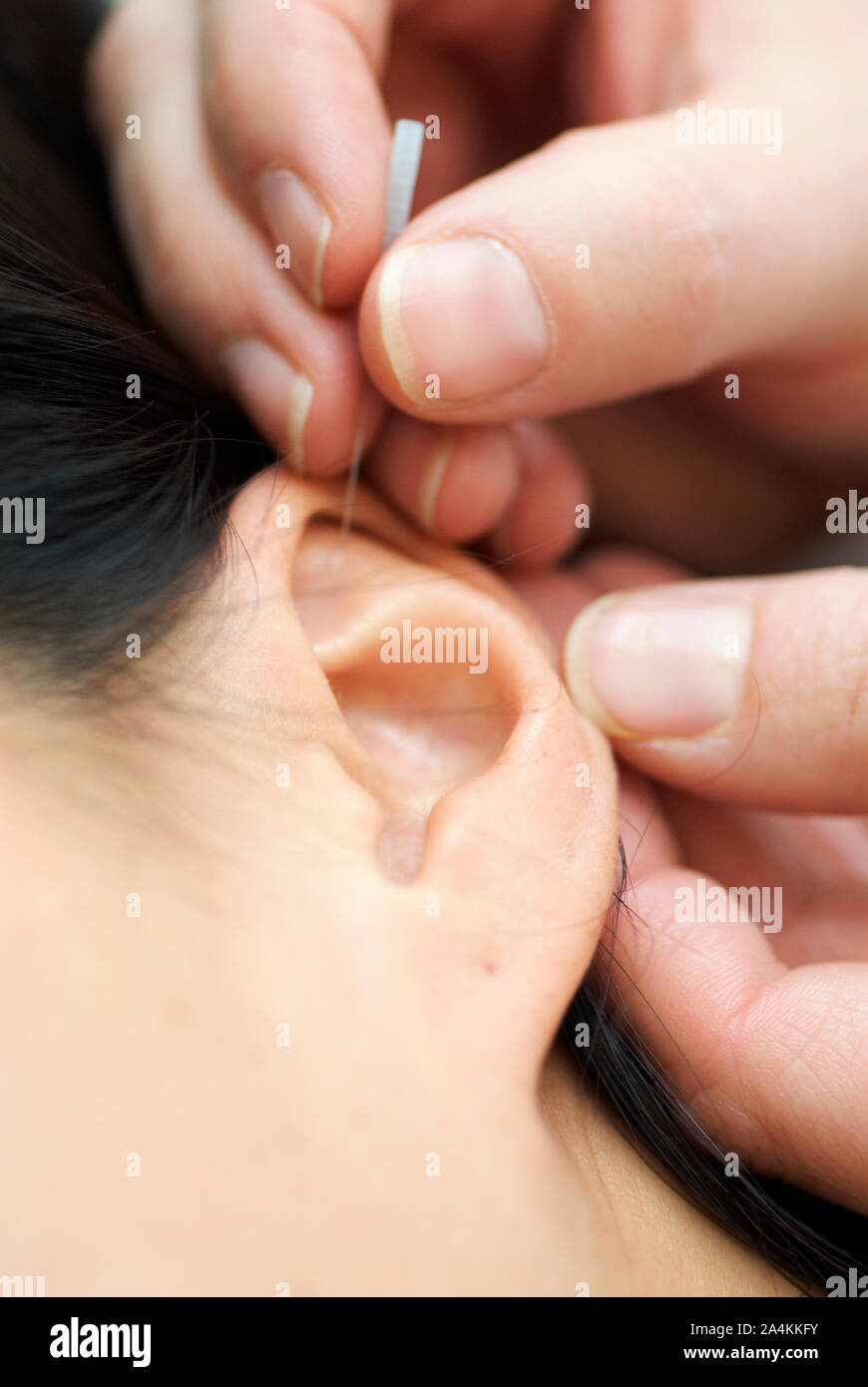 Ear acupuncture hi-res stock photography and images - Alamy