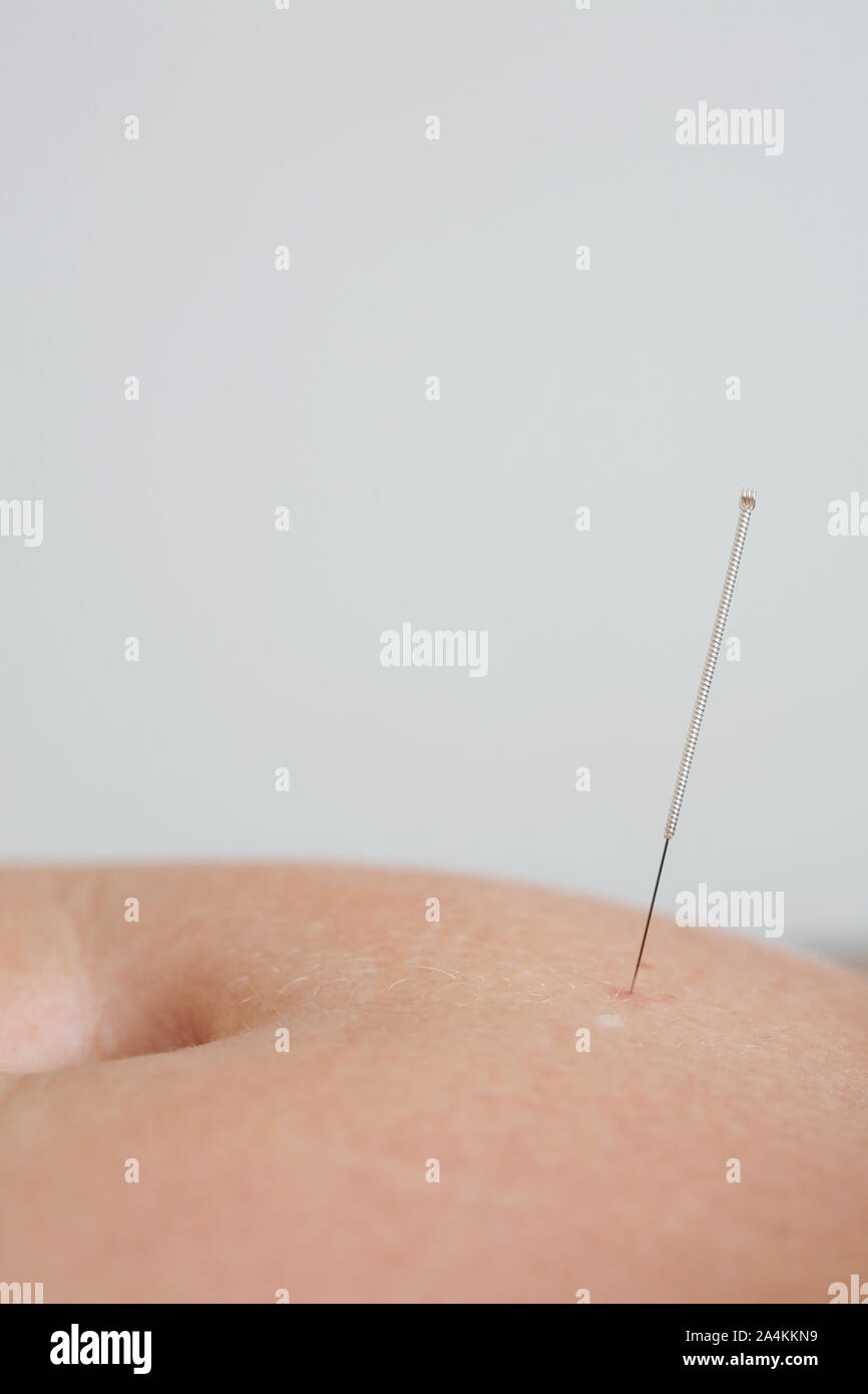 Acupuncture 1 hi-res stock photography and images - Alamy