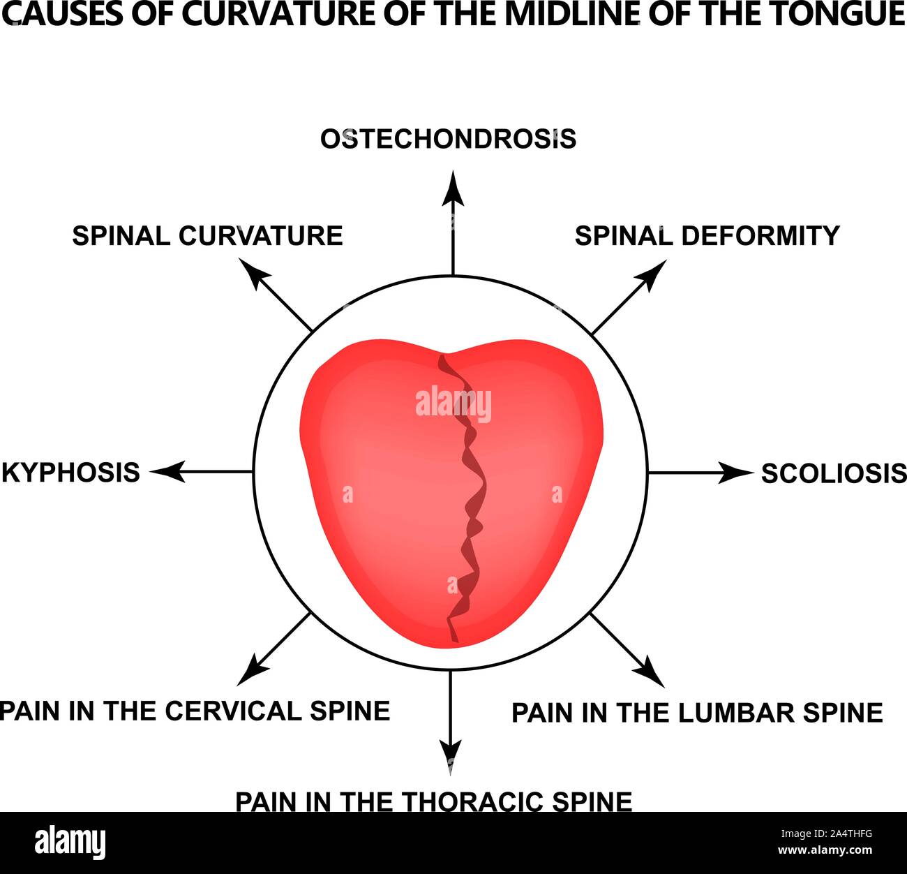Causes of curvature of the midline of the tongue. Definition of a ...