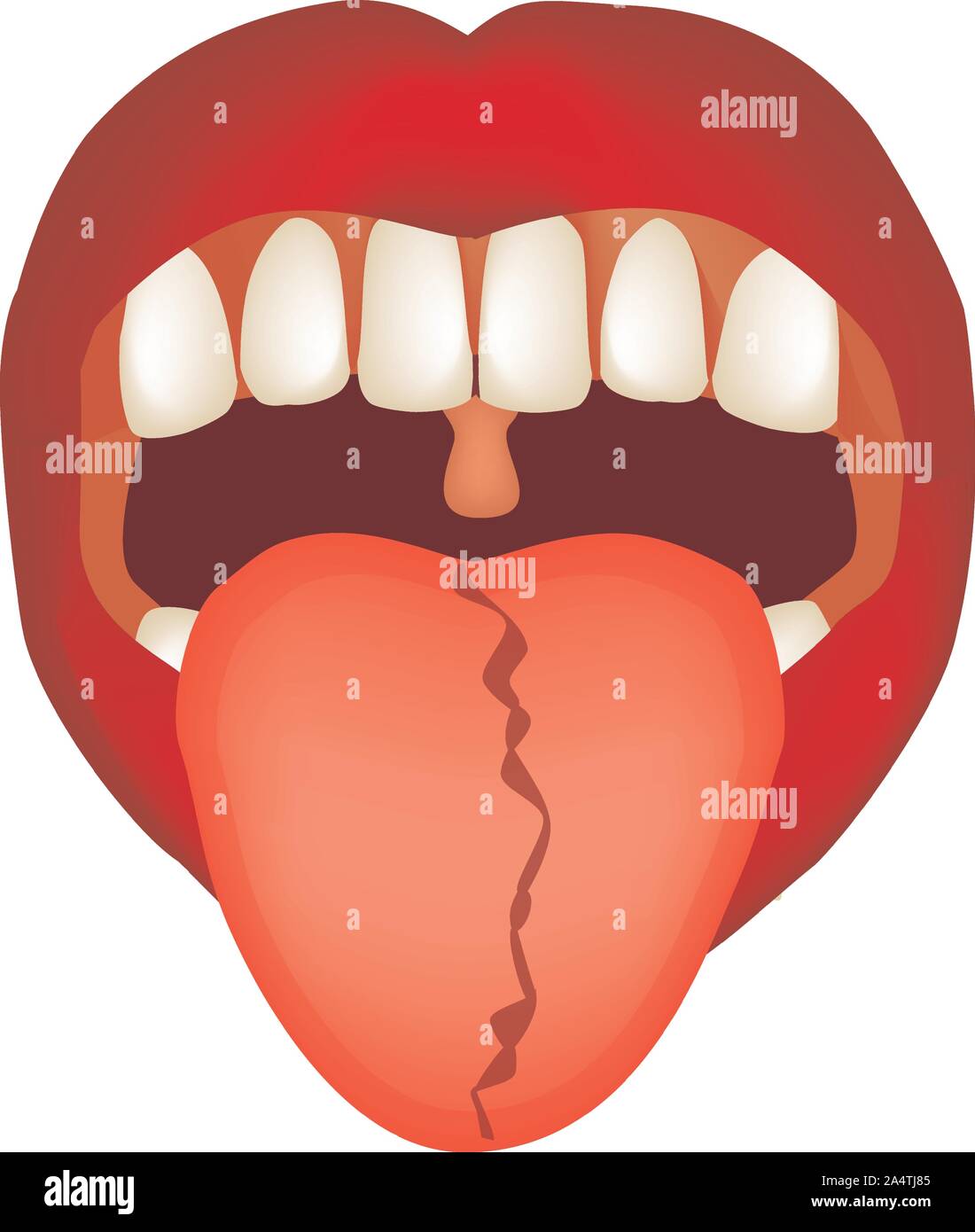 Curvature of the midline of the tongue. Definition of a disease ...