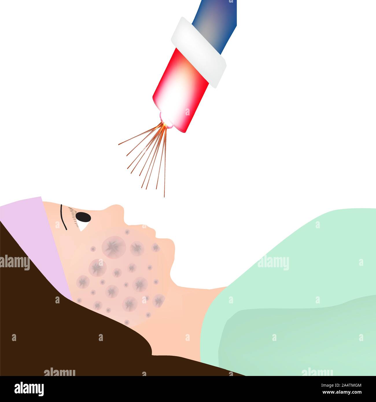 Skin scars after acne and pimples. Treatment of scars on the skin of ...