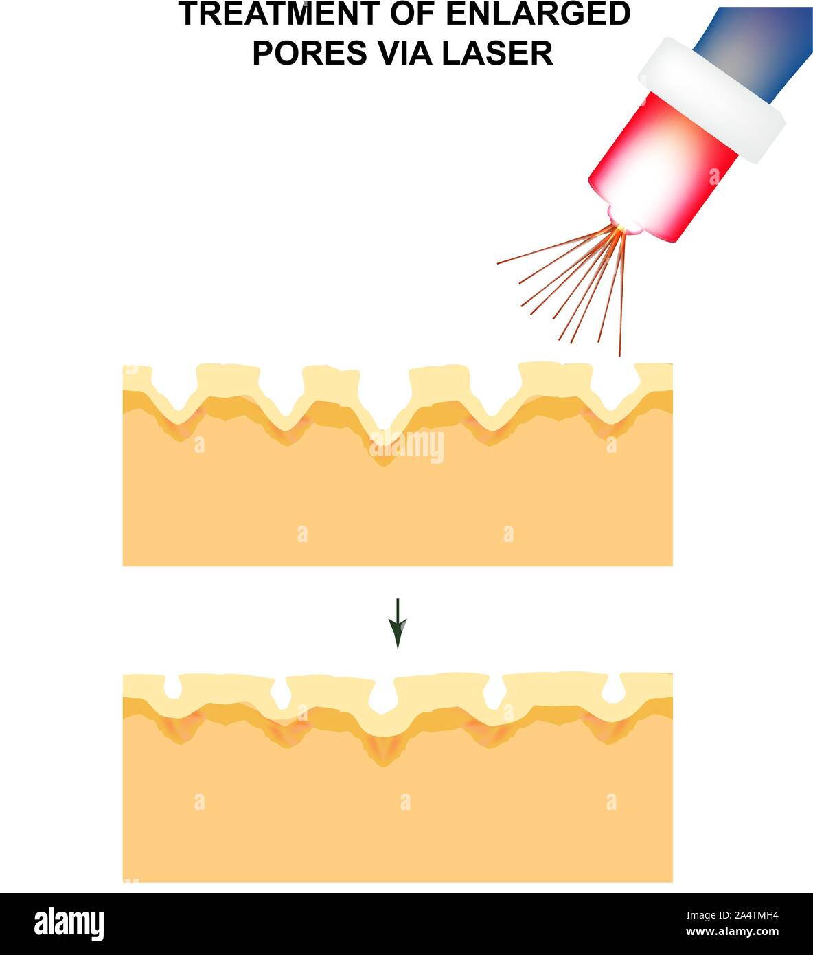 Enlarged pores. The structure of the skin. Wrinkles, acne scar. The ...