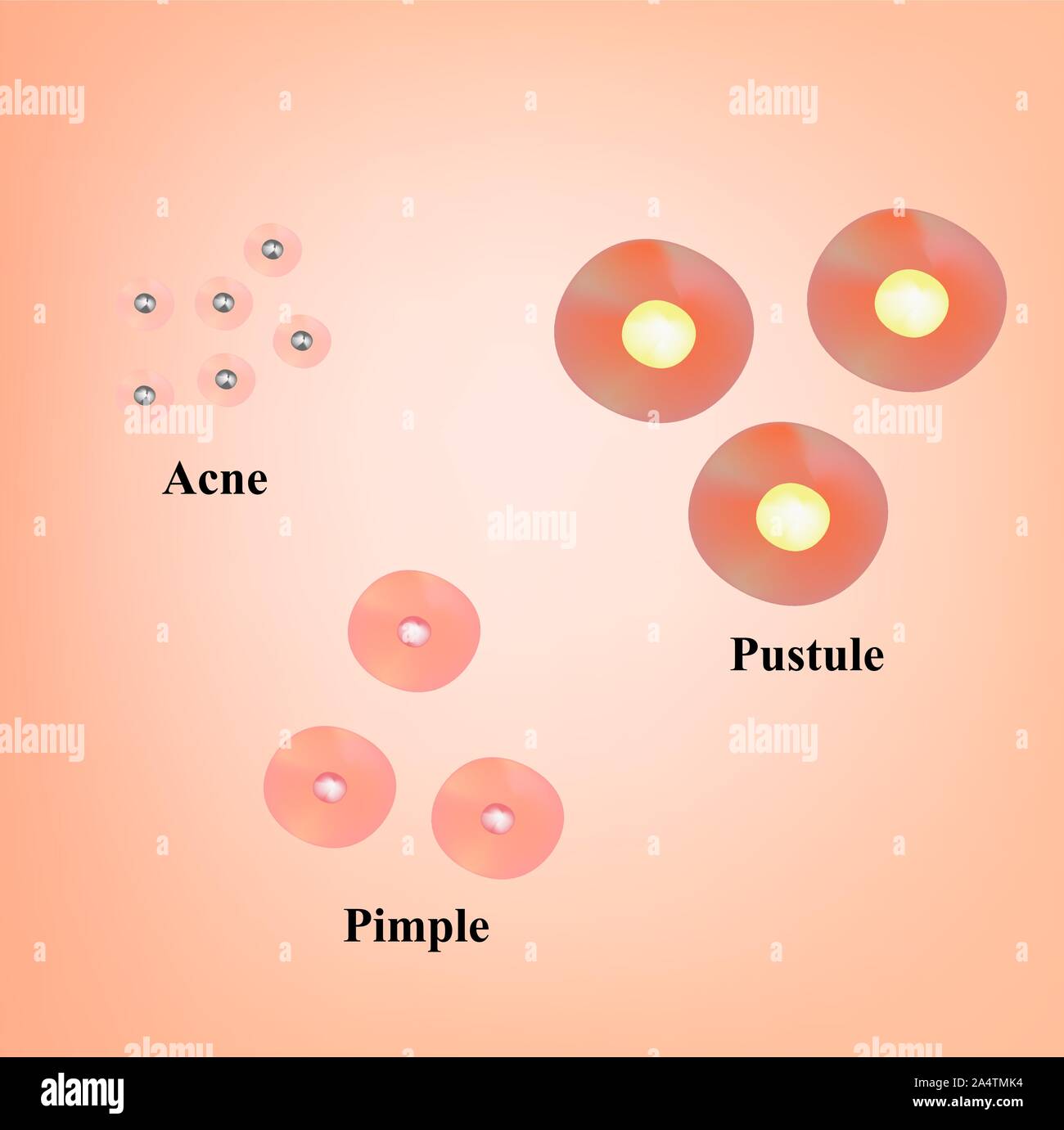 Types of blackheads, pustule, acne. Scarred skin after acne and acne ...