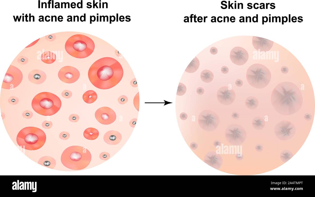 Types of blackheads, pustule, acne. Scarred skin after acne and acne ...