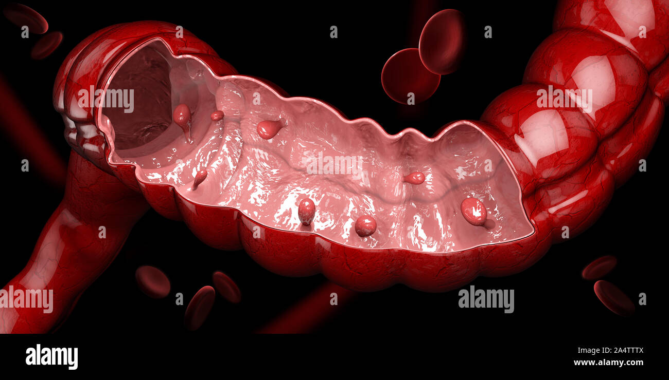 Human colon polyp hi-res stock photography and images - Alamy