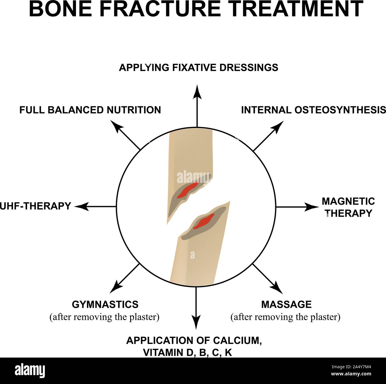Treatment of bone fractures. Bone fracture with displacement ...