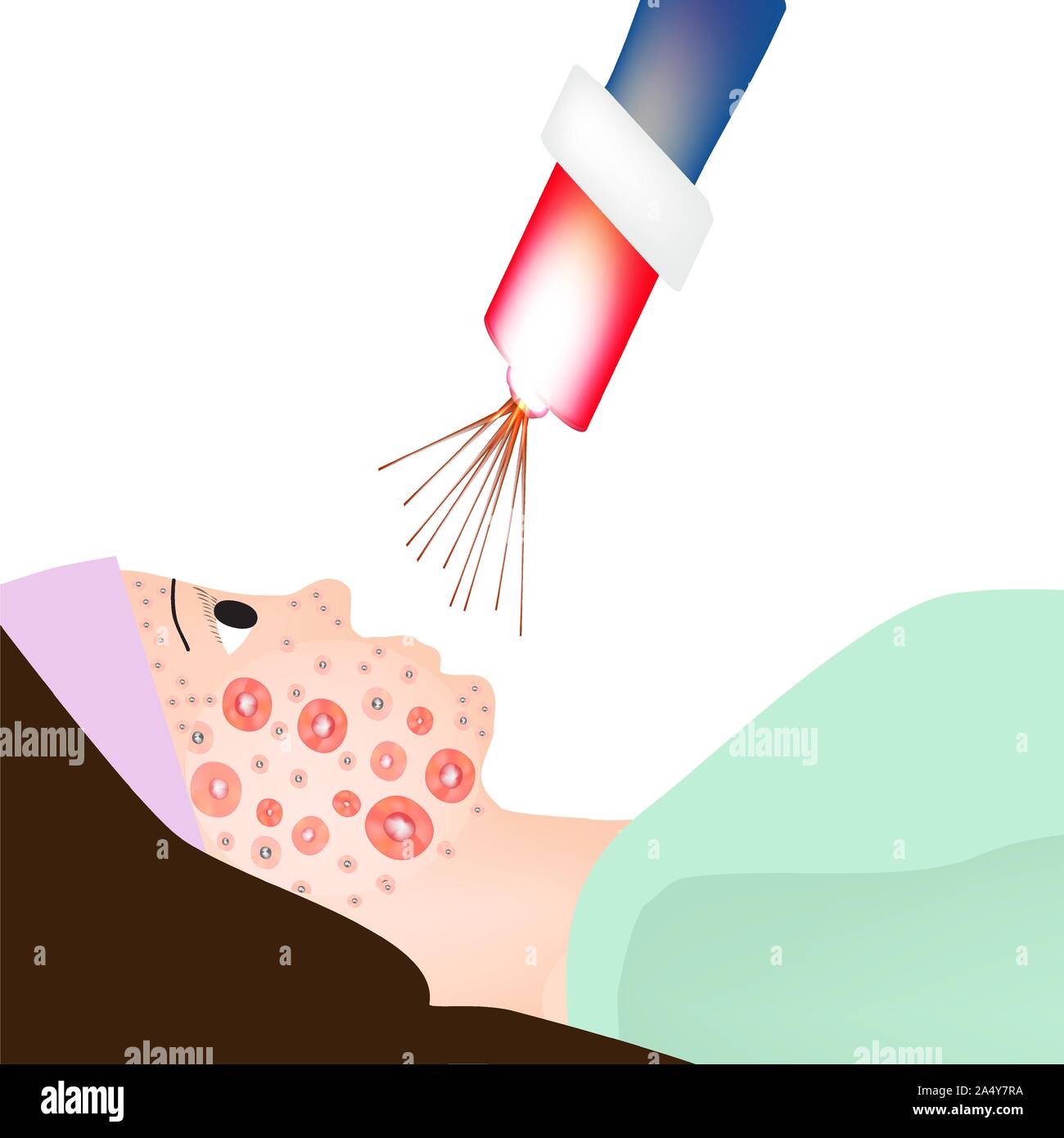 Inflamed Skin with scars, blackheads and pimples. Treatment of acne on ...