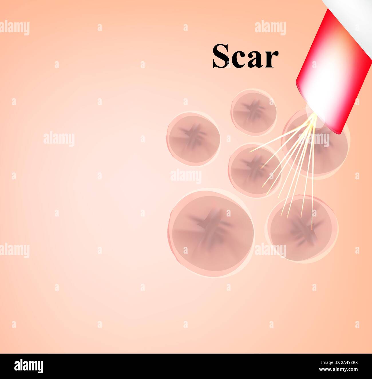 Skin scars after acne and pimples. Treatment of scars on the skin of ...