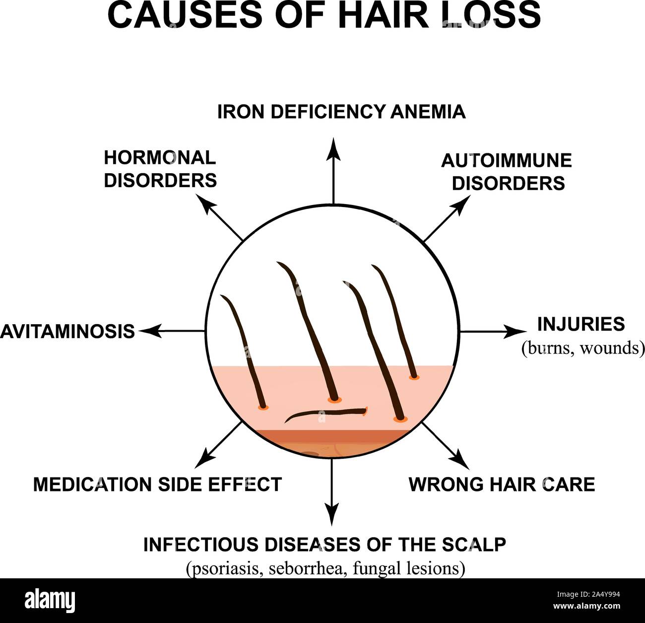 Causes of hair loss. The structure of the skin and hair. Infographics ...