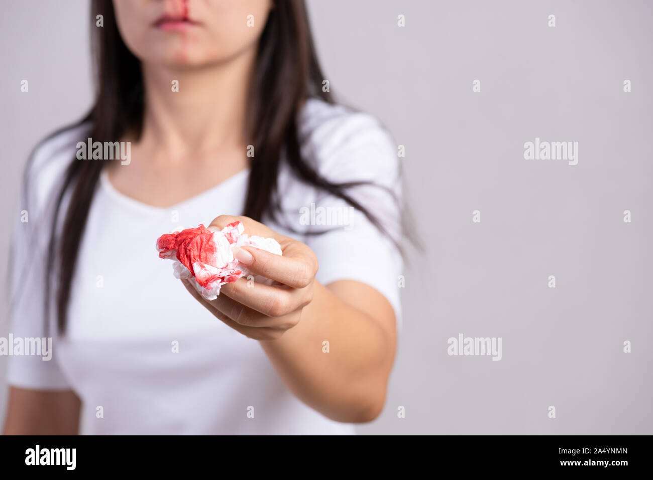 Epistaxis Stock Photos & Epistaxis Stock Images - Alamy