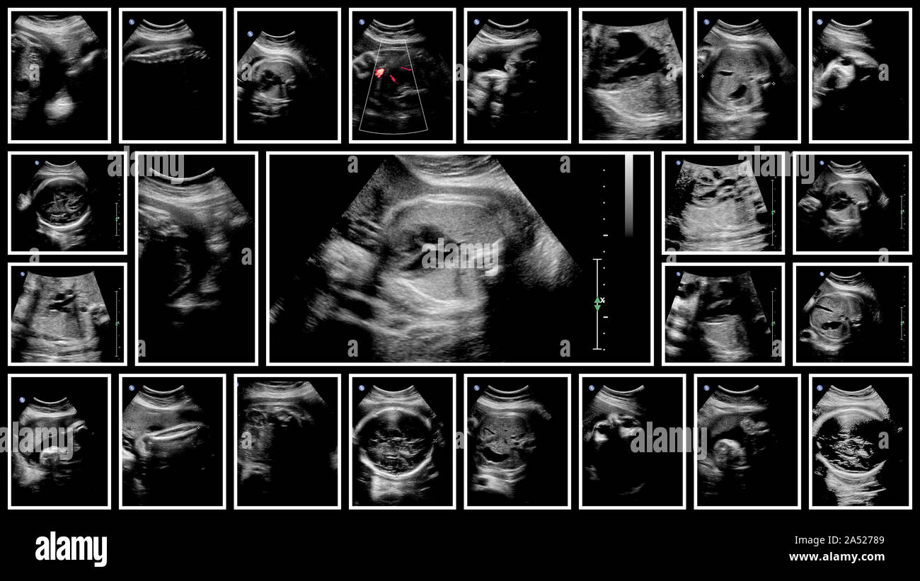 Collection of images from ultrasound scan examination. Fetus in the 7th ...
