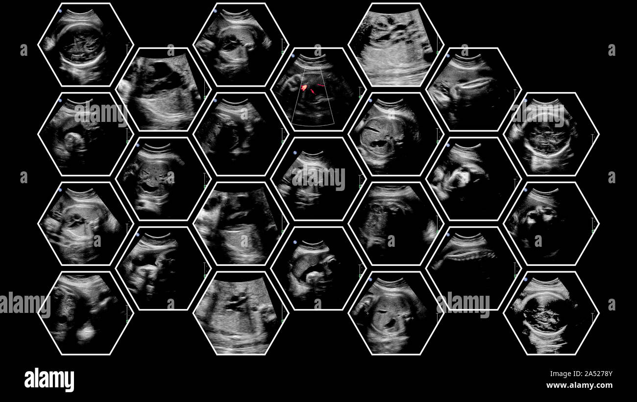 Beehive shape of ultrasound images composition Stock Photo - Alamy