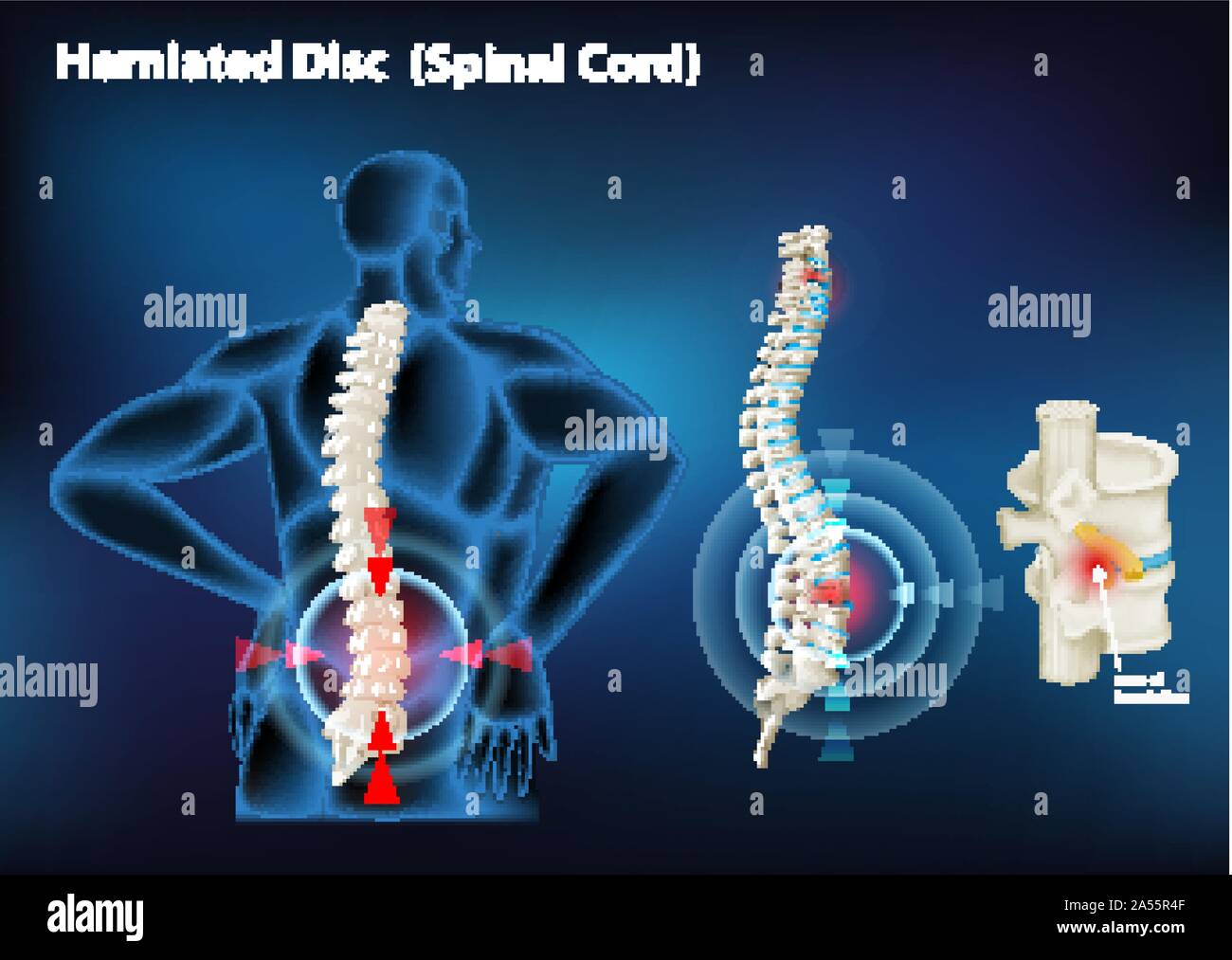 Herniated disc Stock Vector Images - Alamy