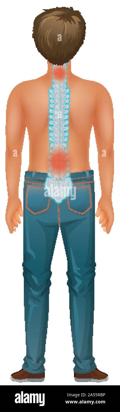 Back of male human with back pain illustration Stock Vector Image & Art ...