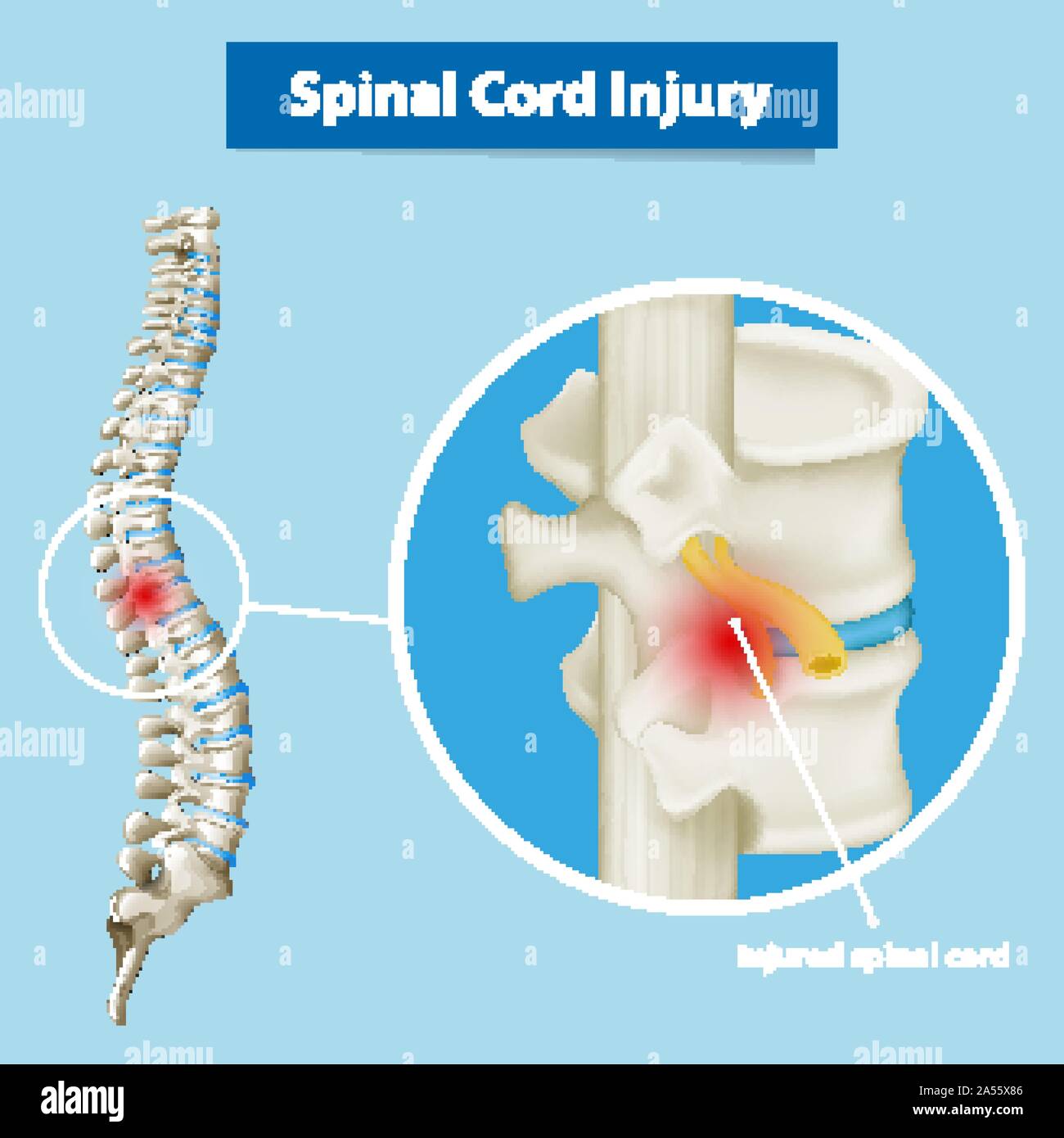 Diagram showing spinal cord injury illustration Stock Vector Image ... Diagram showing spinal cord injury illustration Stock Vector Image ...