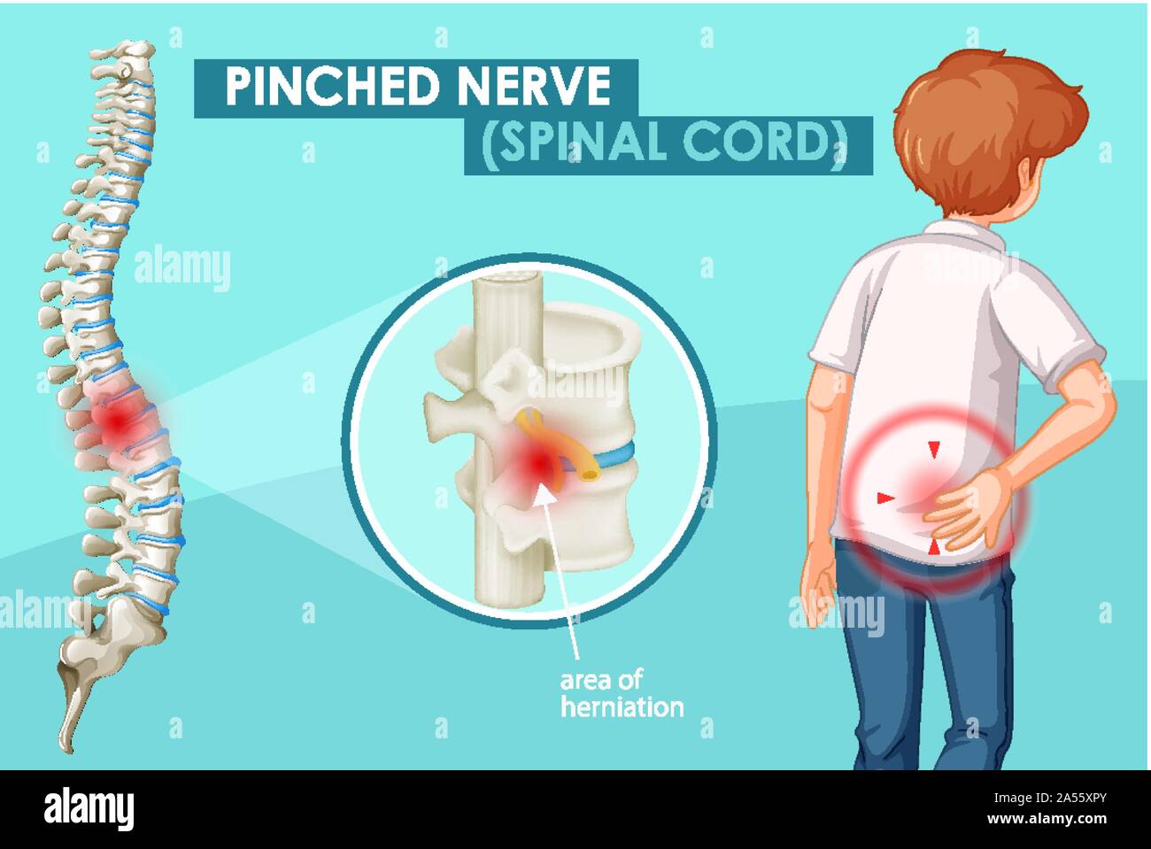 Diagram showing pinched nerve illustration Stock Vector Image & Art - Alamy