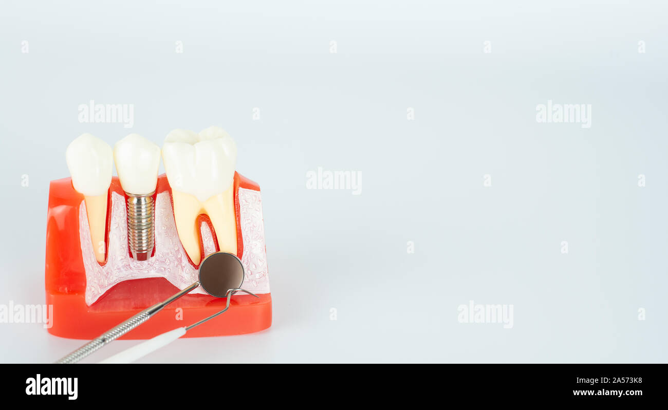Sample dental model that has implants to replace the tooth that has ...