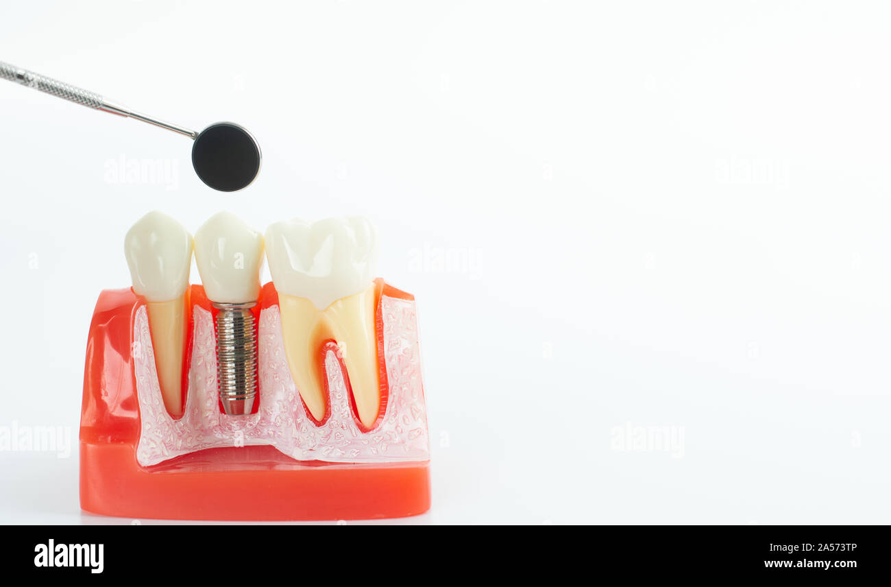 Orthodontic Sample High Resolution Stock Photography and Images - Alamy