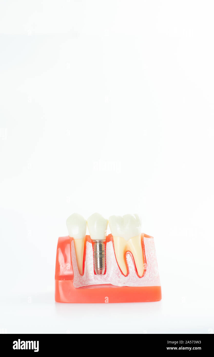 Sample dental model that has implants to replace the tooth that has ...