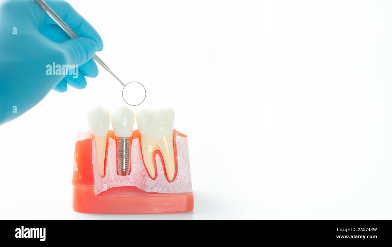 Sample dental model that has implants to replace the tooth that has ...
