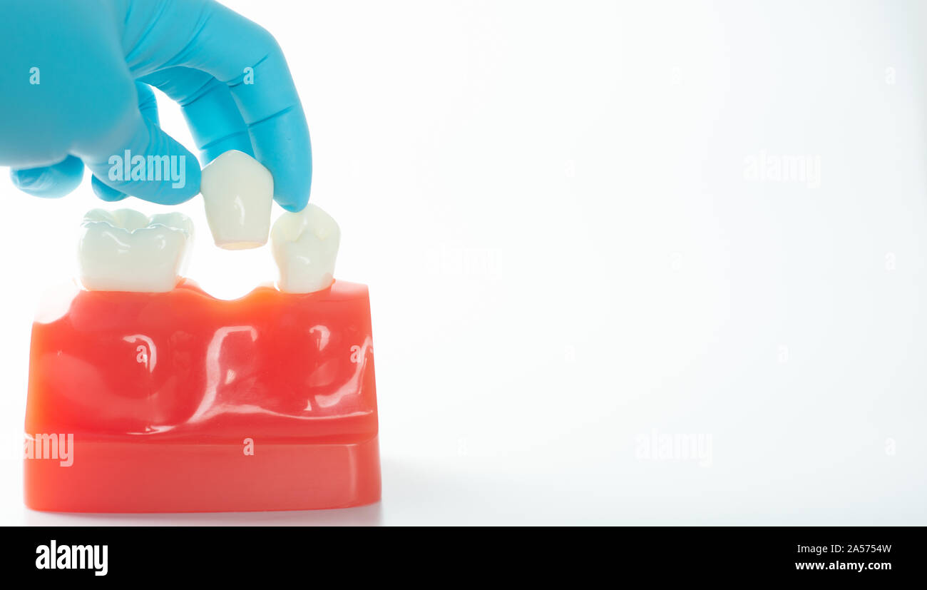 Sample dental model that has implants to replace the tooth that has ...