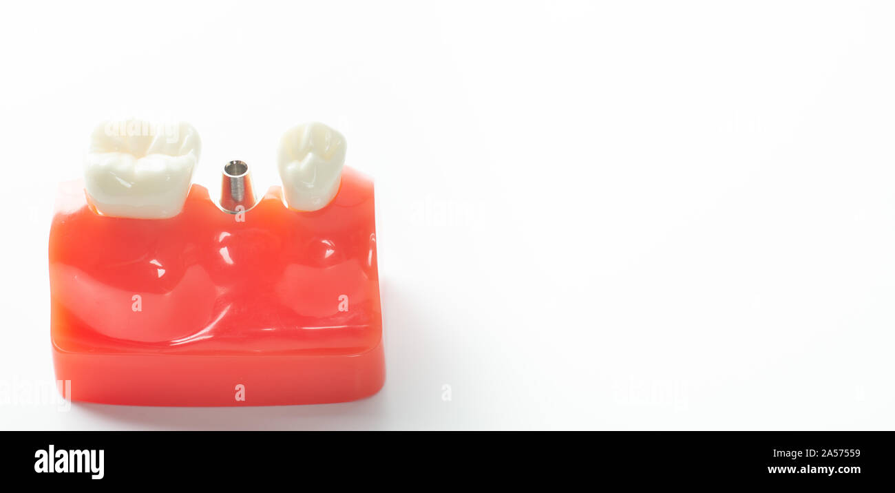 Orthodontic sample hi-res stock photography and images - Alamy