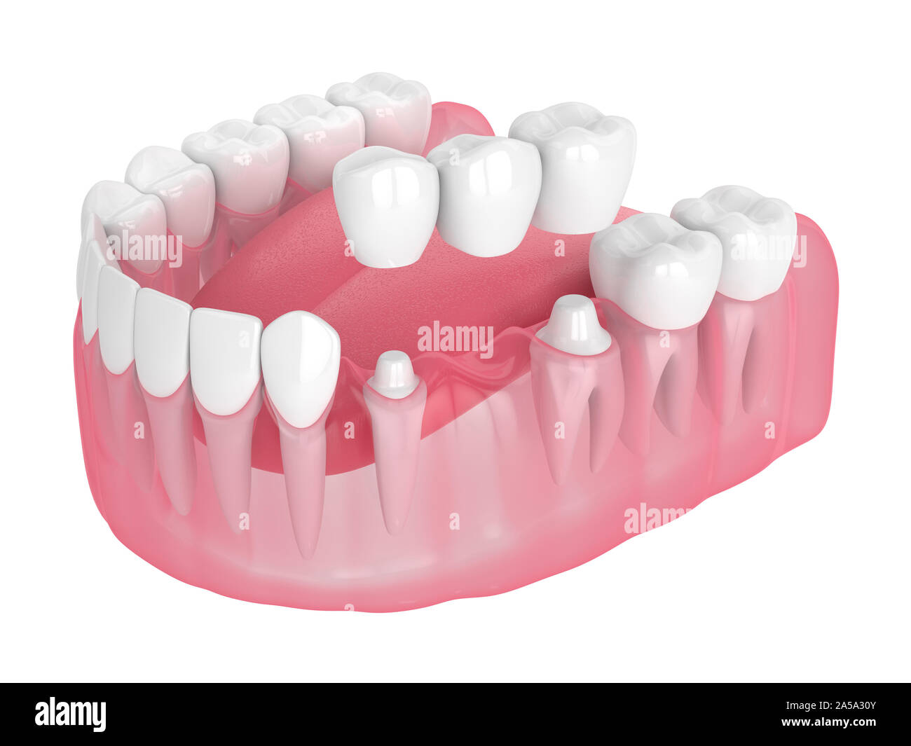 Dental bridge hi-res stock photography and images - Alamy