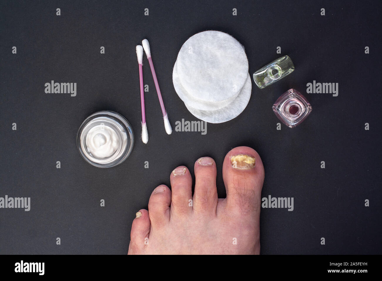 Flat lay. Fungus on the toenail. Cream in a jar, cotton pads and cotton ...
