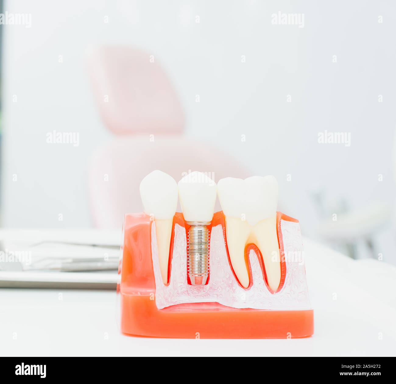Plastic dental implant model for education patient Stock Photo - Alamy