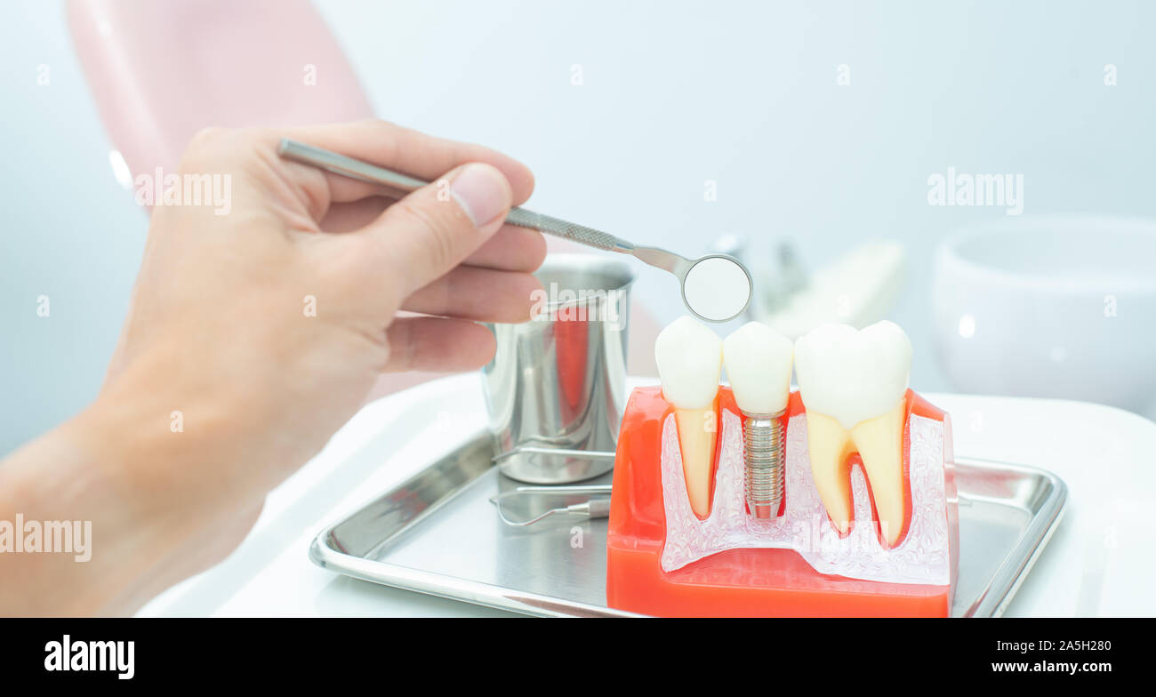 Plastic dental implant model for education patient Stock Photo - Alamy