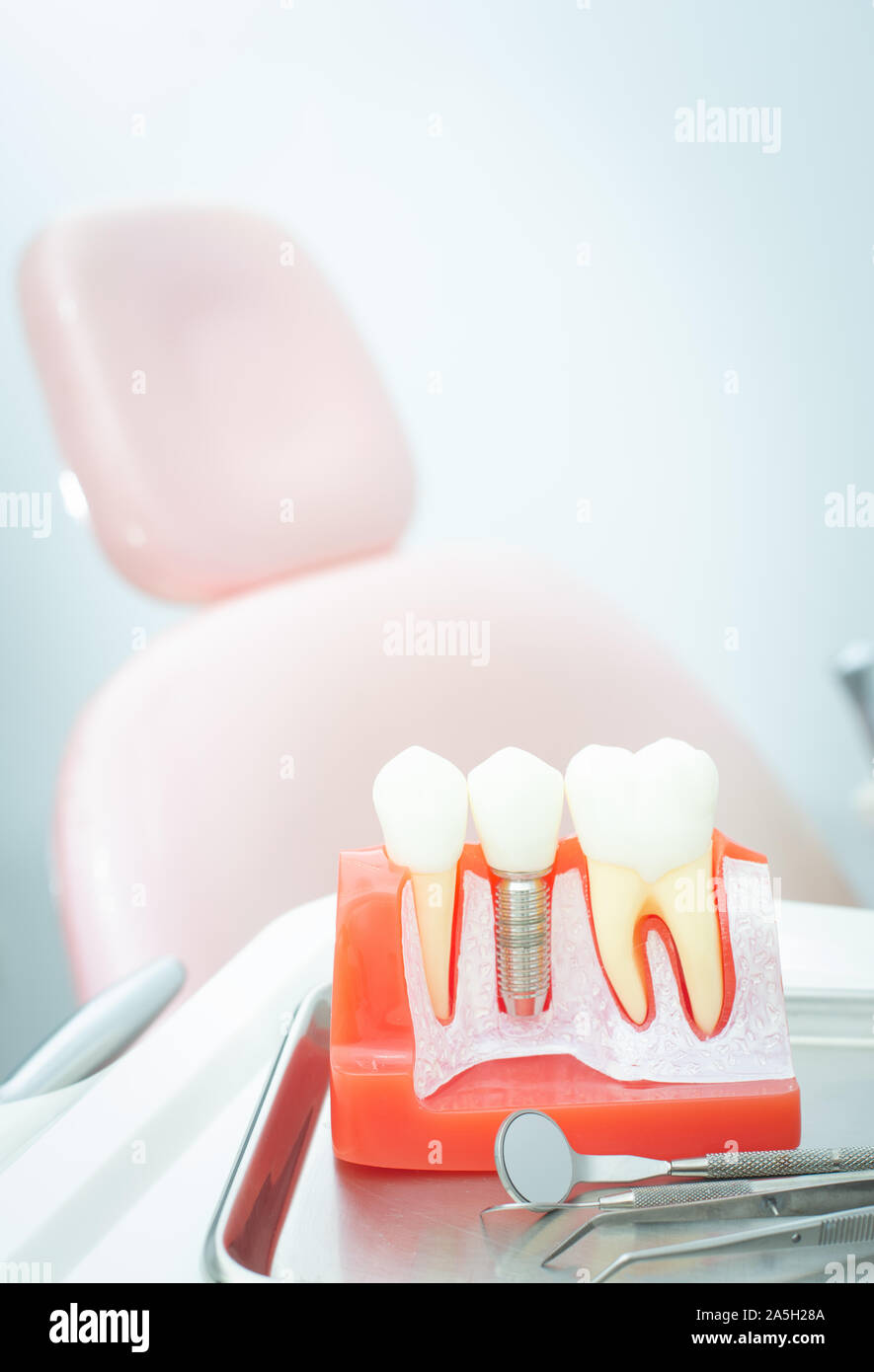 Plastic dental implant model for education patient Stock Photo - Alamy