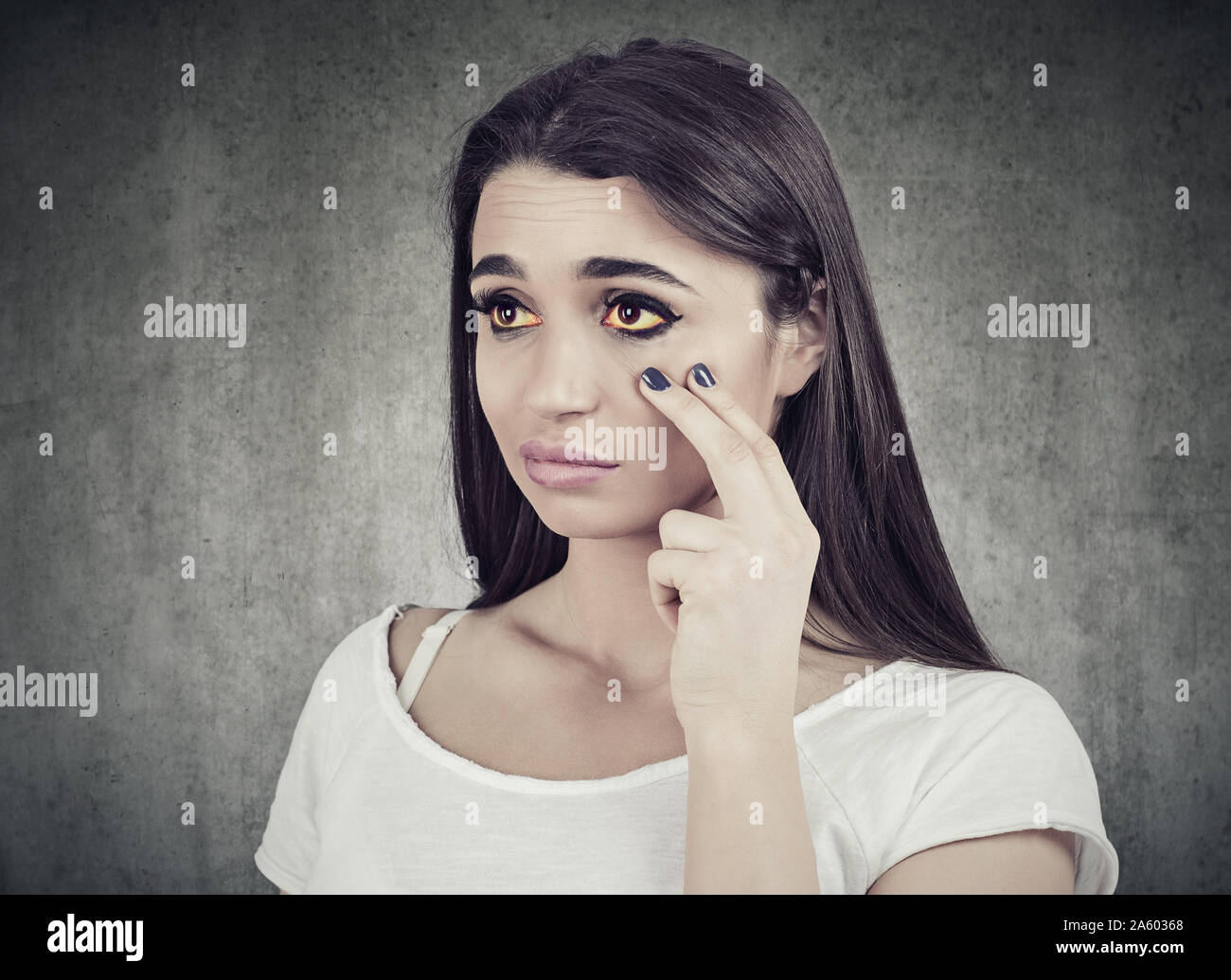 Liver disease skin hi-res stock photography and images - Alamy