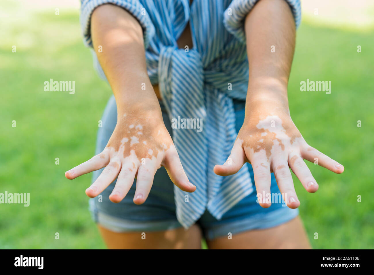 Detail of the hands of a girl with skin depigmentation or vitiligo ...