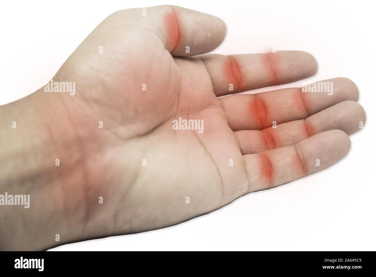 Rheumatoid Arthritis, Trigger finger, arthritis, wrist pain isolated on ...