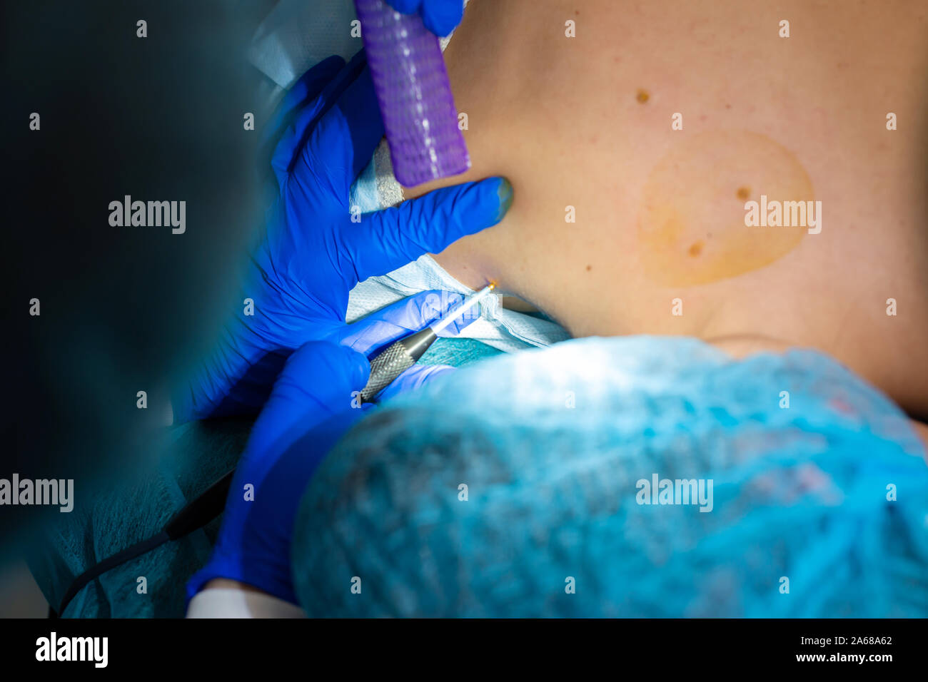 Close-up surgeon burns a mole on the back of the patient. Mole Removal ...