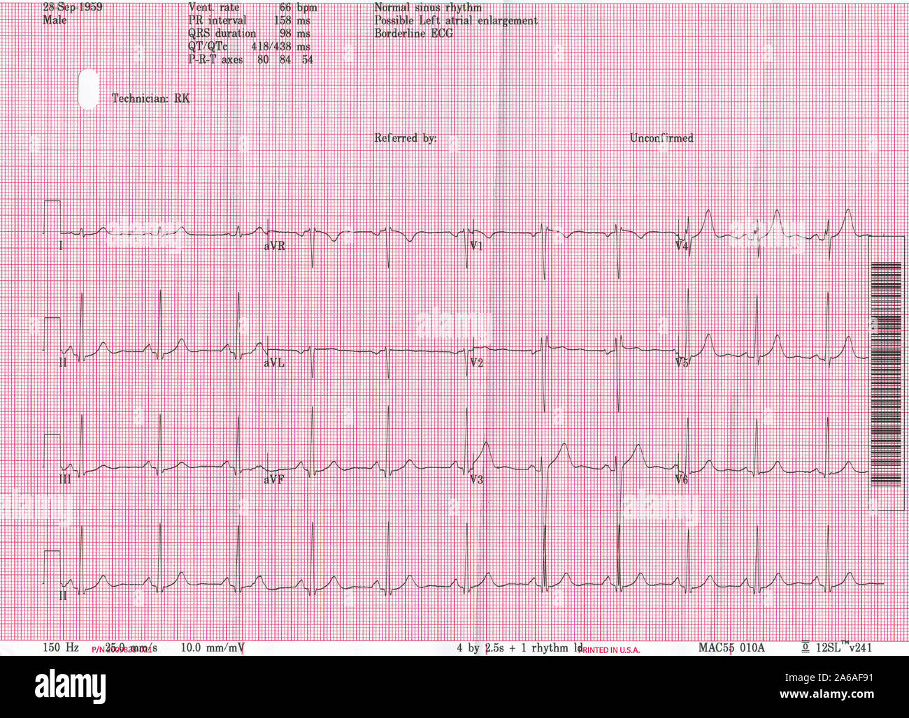 Ekg readout hi-res stock photography and images - Alamy