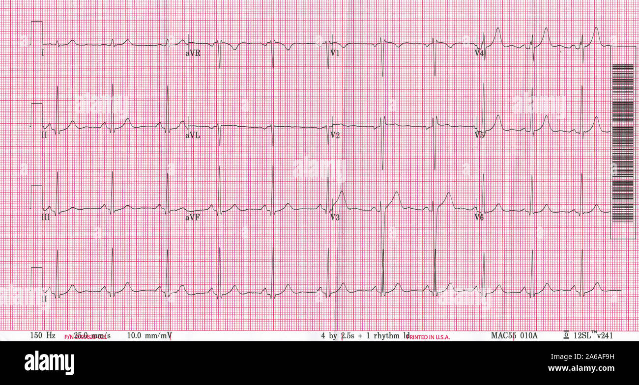 A copy of an ECG (Electrocardiogram) readout from a 60 year-old British ...
