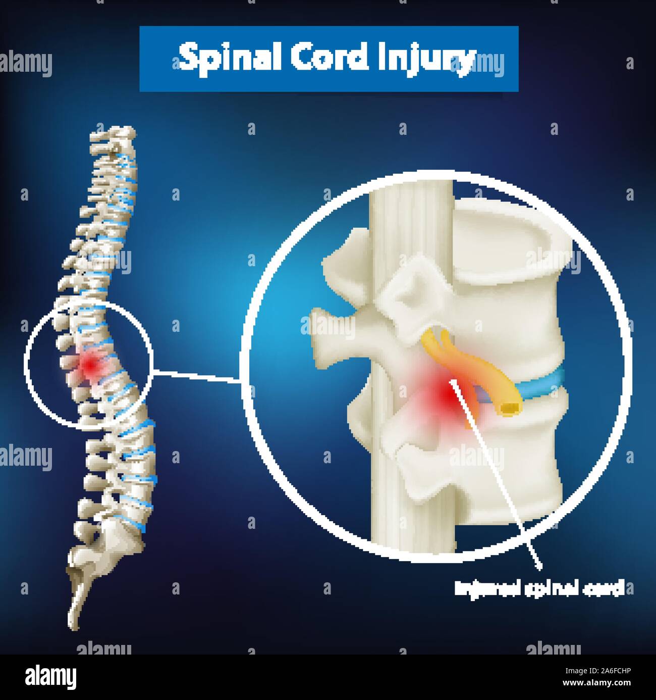 Diagram showing spinal cord injury illustration Stock Vector Image ...